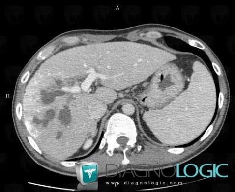 Cas radiologie : Nécrose des voies biliaires (Scanner) - Diagnologic