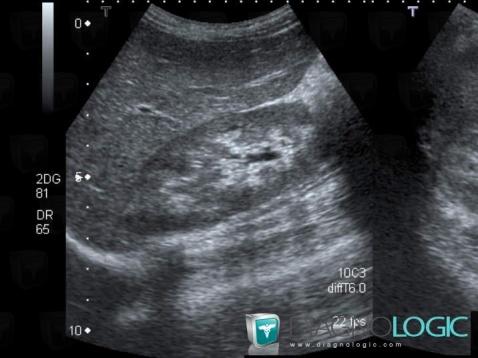 Cas radiologie : Néphrocalcinose (Echographie) - Diagnologic