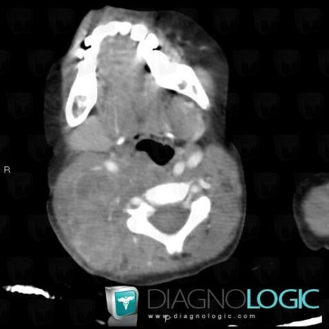 Cas radiologie : Neuroblastome (Scanner ,Radio) - Diagnologic