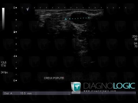 Cas radiologie : Neurofibromatose (Echographie ,IRM ,Scanner) - Diagnologic