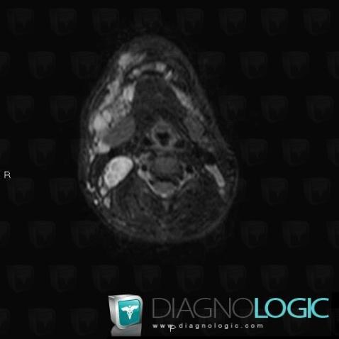 Cas radiologie : Neurofibrome (IRM) - Diagnologic