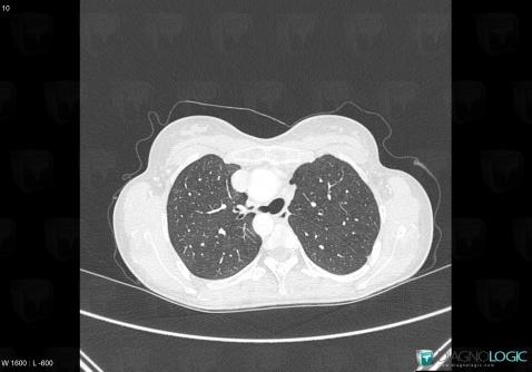 Radiology case : Normal variant (CT) - Diagnologic