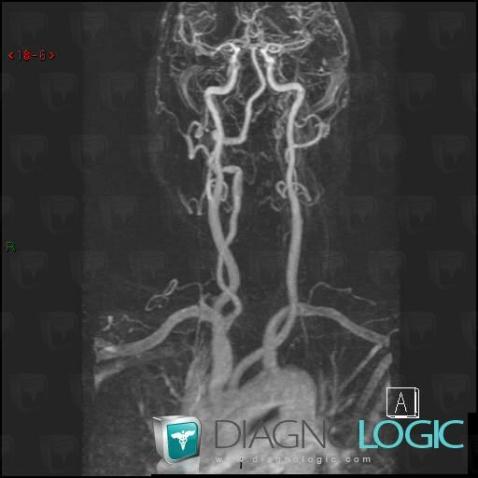 Radiology case : Normal variant (MRI) - Diagnologic