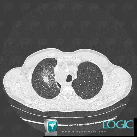 Cas radiologie : Cancer broncho pulmonaire (Scanner) - Diagnologic