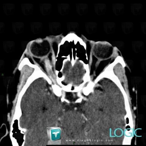 Radiology case : Sarcoidosis (CT ,MRI) - Diagnologic