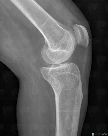 Cas radiologie : Os méniscal (IRM ,Radio) - Diagnologic