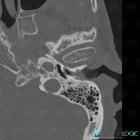 Osteite (IRM ,Scanner ,Radio) - Diagnologic