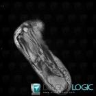 Osteite (IRM ,Scanner ,Radio) - Diagnologic