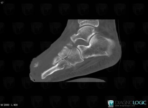 Cas radiologie : Osteite (Scanner) - Diagnologic