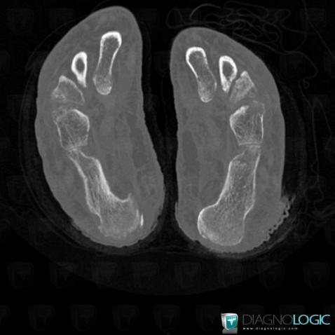 Radiology case : Osteitis (CT) - Diagnologic