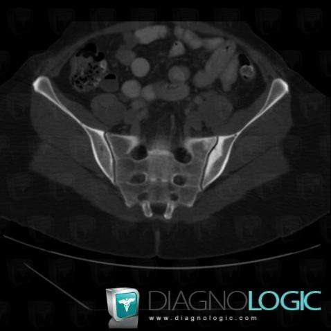Radiology case : Osteitis condensans ilii (CT) - Diagnologic