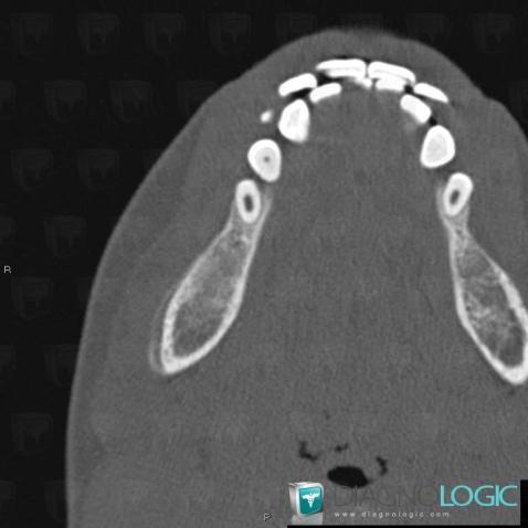 Radiology case : Osteitis (CT) - Diagnologic
