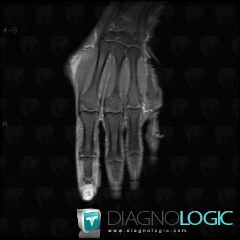 Radiology case : Osteitis (MRI ,X rays) - Diagnologic