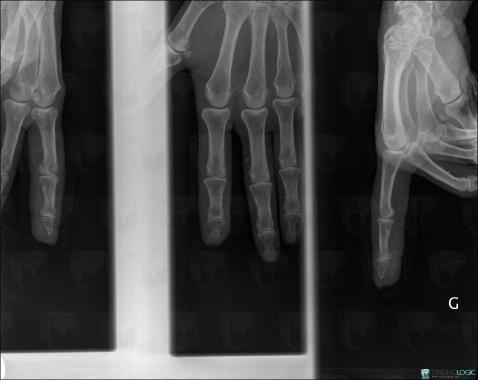 Radiology case : Osteitis (MRI ,X rays) - Diagnologic