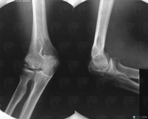 Radiology case : Osteochondritis dissecans (X rays) - Diagnologic