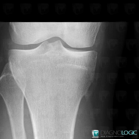 Radiology case : Osteochondroma (X rays) - Diagnologic