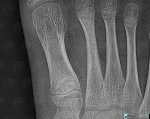 Cas radiologie : Ostéomyélite (Scanner ,Radio) - Diagnologic