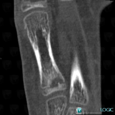 Cas radiologie : Ostéomyélite (Scanner ,Radio) - Diagnologic