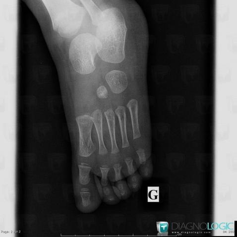 Radiology case : Osteomyelitis (X rays) - Diagnologic