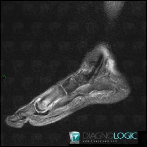 Radiology case : Osteomyelitis (MRI) - Diagnologic