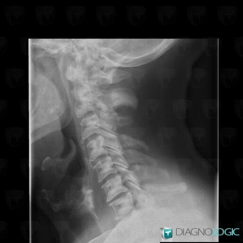 Cas radiologie : Ostéopétrose (Radio) - Diagnologic