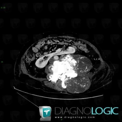 Radiology case : Osteosarcoma (CT) - Diagnologic