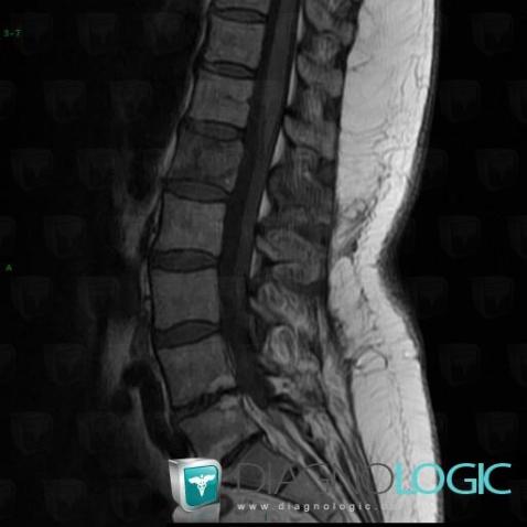 Radiology case : Paget disease (MRI ,X rays) - Diagnologic
