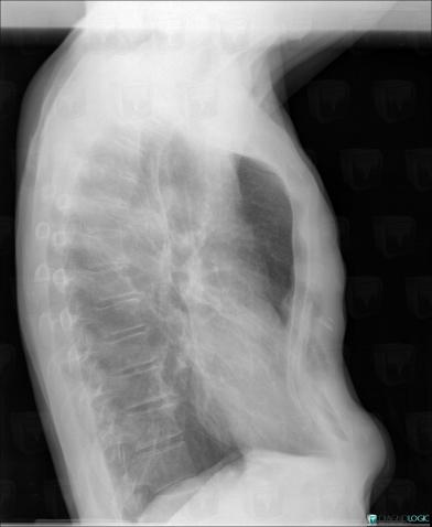Radiology case : Pectus excavatum (X rays) - Diagnologic