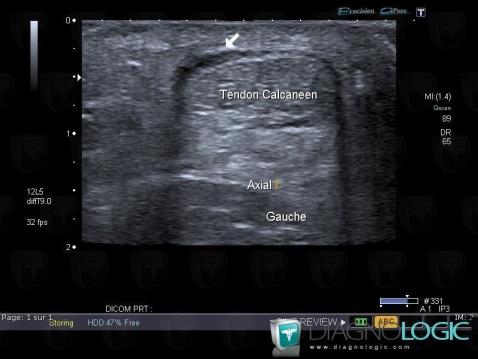 Cas radiologie : Péritendinopathie calcanéenne (Echographie) - Diagnologic