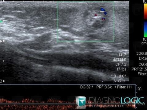 Cas radiologie : Pilomatricome (Echographie) - Diagnologic