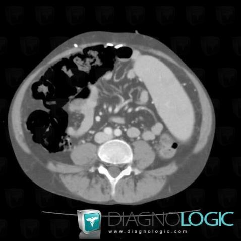 Cas radiologie : Pneumatose kystique intestinale (Scanner) - Diagnologic