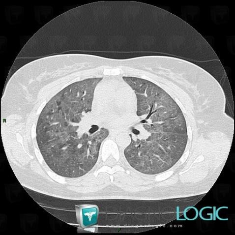 Cas radiologie : Pneumocystose (Scanner) - Diagnologic