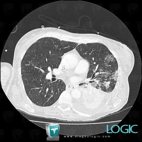 Cas radiologie : Pneumopathie d'inhalation (Scanner) - Diagnologic