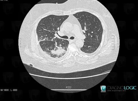 Cas radiologie : Pneumopathie d'origine médicamenteuse (Scanner ...