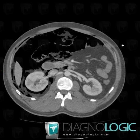 Radiology case : Foreign body (CT) - Diagnologic