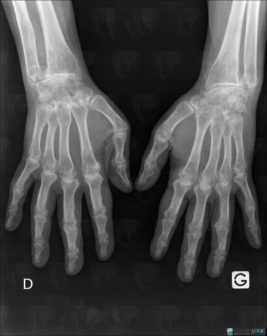 Cas radiologie : Polyarthrite rhumatoïde (Radio) - Diagnologic