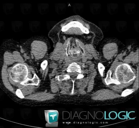 Cas radiologie : Polychondrite atrophiante (Scanner) - Diagnologic