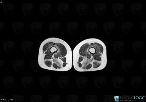 Cas radiologie : Polymyosite (IRM) - Diagnologic