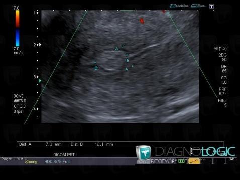 Cas radiologie : Polype (Echographie) - Diagnologic
