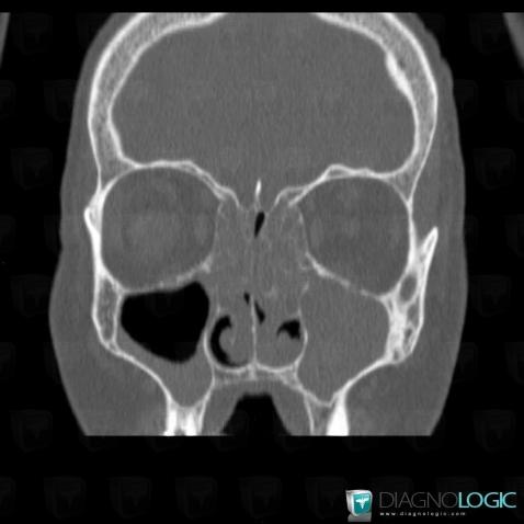 Cas radiologie : Polypose naso sinusienne (Scanner) - Diagnologic