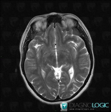 Radiology case : Multiple sclerosis (MRI) - Diagnologic