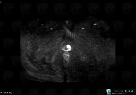 Radiology case : Prostate cancer (MRI) - Diagnologic