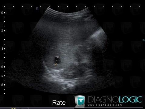 Cas radiologie : Pseudokyste splénique (Echographie) - Diagnologic