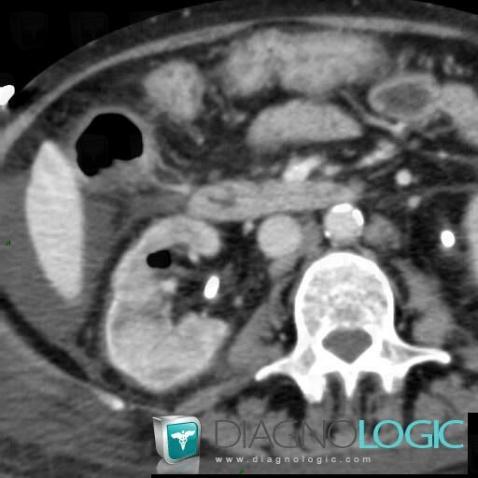 Cas radiologie : Pyélonéphrite emphysémateuse (Scanner) - Diagnologic