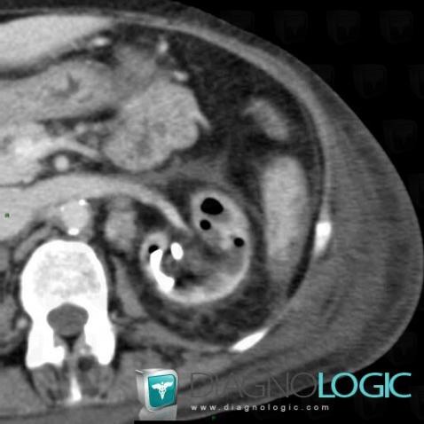 Cas radiologie : Pyélonéphrite emphysémateuse (Scanner) - Diagnologic
