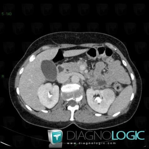 Cas radiologie : Pyélonéphrite (Scanner) - Diagnologic