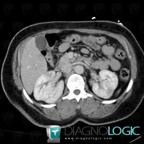Radiology case : Pyelonephritis (CT) - Diagnologic