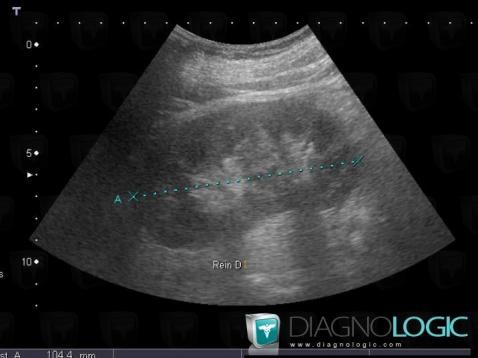 Radiology case : Pyelonephritis (US ,CT) - Diagnologic