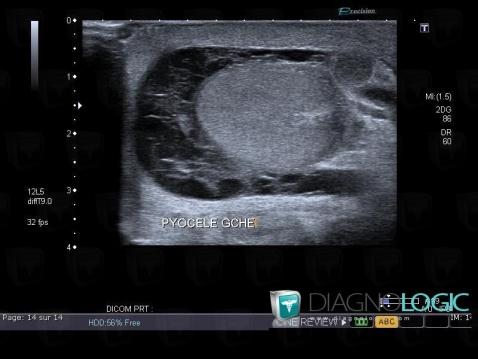 Cas radiologie : Pyocele (Echographie) - Diagnologic