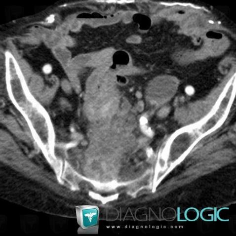 Radiology case : Rectal cancer (CT) - Diagnologic